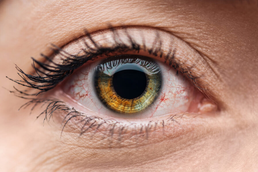 Hypermétropie et presbytie : comment les deux affectent la vision